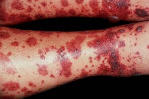 Allergic vasculitis: causes and symptoms