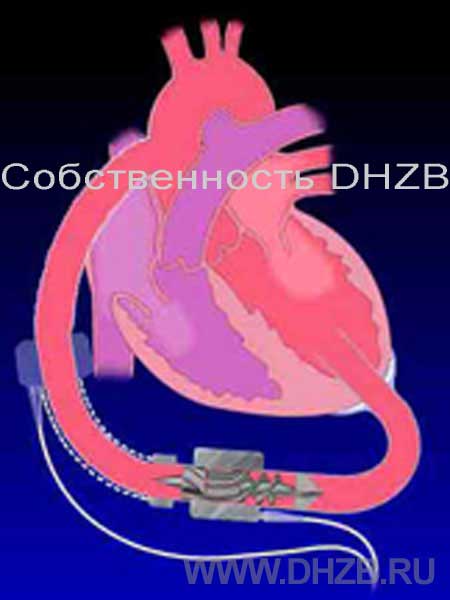 THE WORLD'S FIRST ARTIFICIAL CIRCULATORY DEVICE (ACV) “AUTOJECTOR” S.S ...