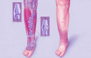 Флебит нижних конечностей: симптомы и лечение в домашних условиях