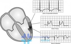 ECG for myocardial infarction (photo with transcript), cardiogram ...