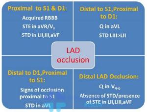 ECG for myocardial infarction (photo with transcript), cardiogram ...