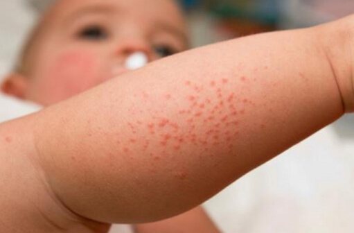 Petechiae on the skin: causes and photos of the rash, symptoms and ...