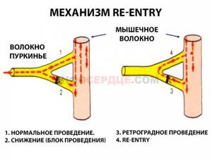 Ventricular extrasystole: causes, diagnosis and treatment