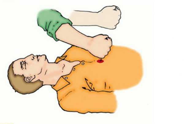 How to deliver a precordial blow. Precordial stroke: indications ...