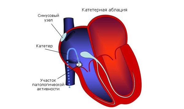 Sinus rhythm with rare supraventricular extrasystoles