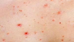 Petechiae on the skin: causes and photos of the rash, symptoms and ...