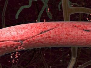 Vascular damage - causes, symptoms, diagnosis and treatment