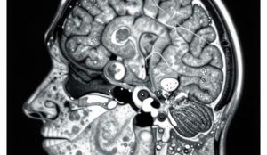 Gliosis of the brain: what is it, treatment, life prognosis