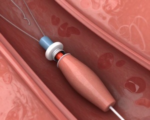 Diabetic angiopathy of the lower extremities: features of the course ...